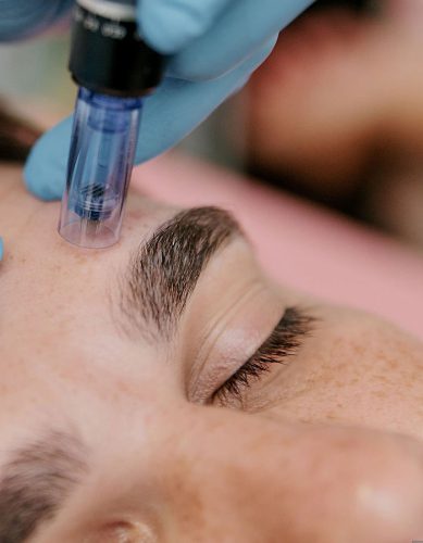 Micro Needling – Elite Wellness Spa